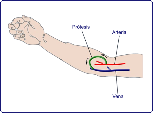 Acceso Vascular
